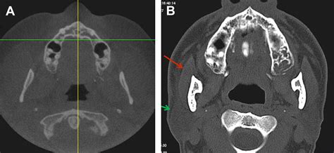 A Comparison Of Maxillofacial Cbct And Medical Ct Atlas Of The Oral
