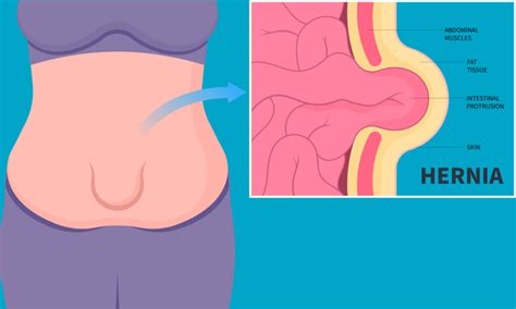 Cirugía De Hernia Ventral Torrance Hernia Center