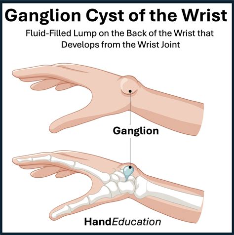 Ganglion Cysts Of The Wrist Hand Education