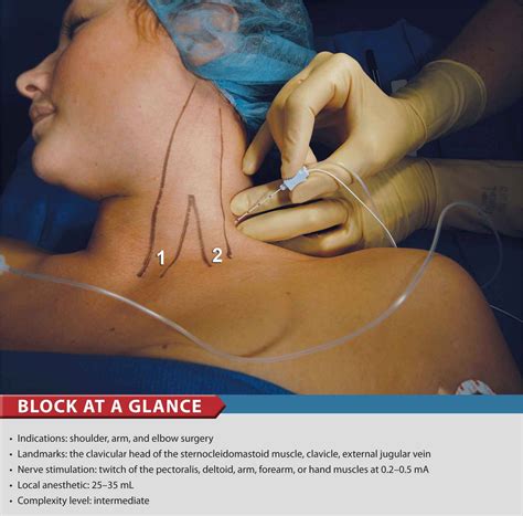 Interscalene Brachial Plexus Block Hadzics Peripheral Nerve Blocks