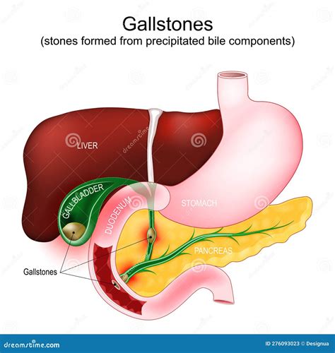 Gallstones Parts Of A Digestive System Gallbladder Duodenum Stomach Liver And Pancreas