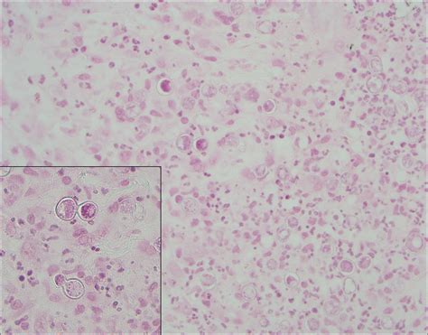Orange Nodules On The Scalp Mdedge Dermatology