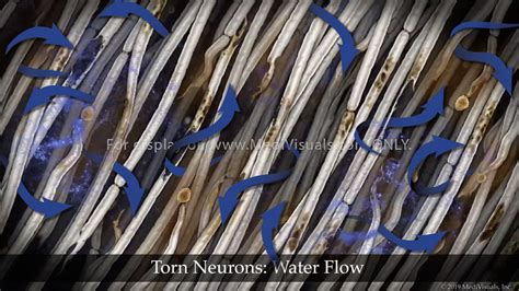 Why Can Brain Injuries Be Imaged With DTI Diffuse Tensor Imaging That