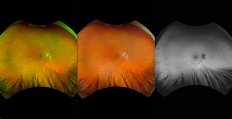 California Idiopathic Choroidal Folds Rg Rgb Baf