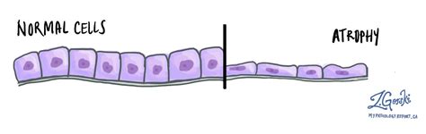 Atrophie Mypathologyreport