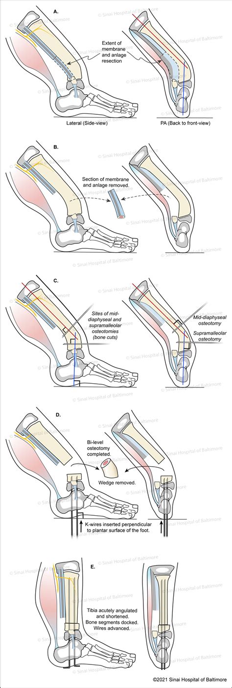 Fibular Hemimelia Diagram