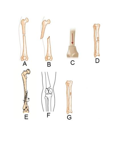 Stt3 Fracture Diagram Diagram Quizlet