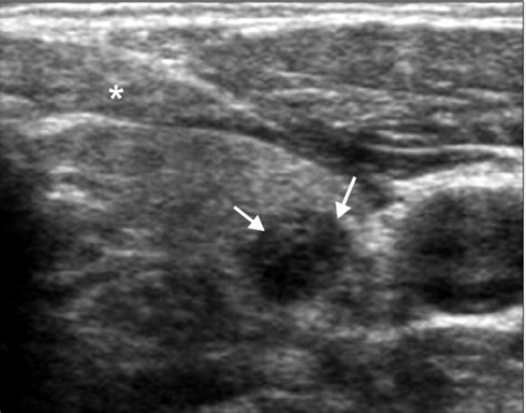 Marked Hypoechogenicity Of The Nodule The Echogenicity Of The Thyroid