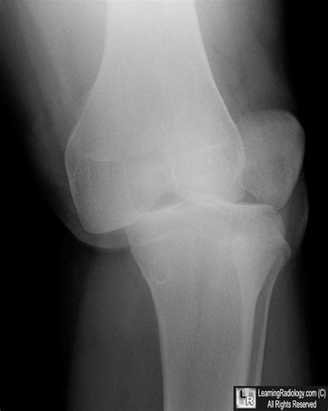Knee Dislocation Experiences Not Kneecap Knee Joint Dislocations