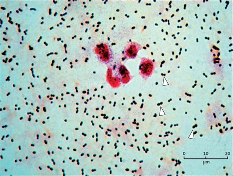 Pathogenesis Treatment And Prevention Of Pneumococcal Pneumonia The