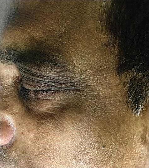 Facial Acanthosis Nigricans A Morphological Marker Of Metabolic