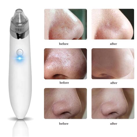 Electric USB Charge Vacuum Blackhead Removal Acne Blemish Remover ...