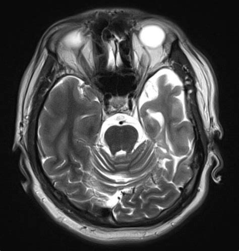 Mri Scan Axial T2 Sequence Show Left Temporal Lobe Atrophy With Download Scientific Diagram