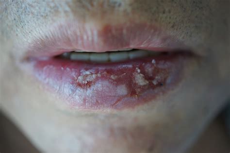 Causas De Los Labios Hinchados Y Cómo Lidiarlos