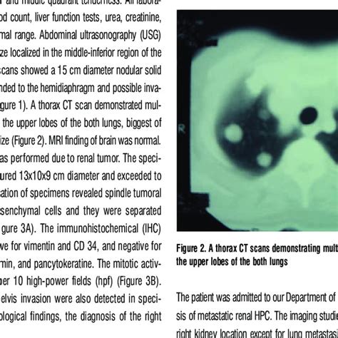 Abdominopelvic Ct Scans Showing A 15 Cm Diameter Nodular Solid Lesion