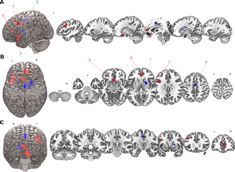 Map Of Brain Activations And Deactivations Associated With Placebo Download Scientific Diagram