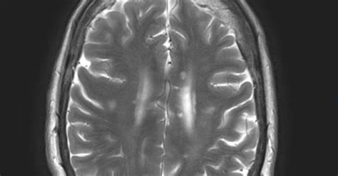 Syndroom Van Susac Ntvg