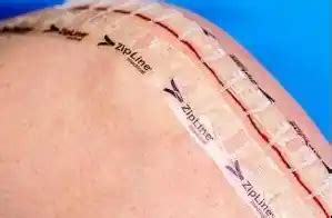 Stryker Skin Closure Zip Strip Zipline Medical 1 Inch X 24 Cm Zip Close