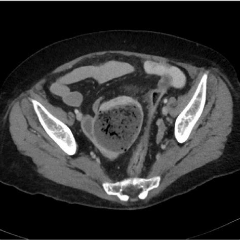 Coronal Ct Scan Of Intussusception Download Scientific Diagram