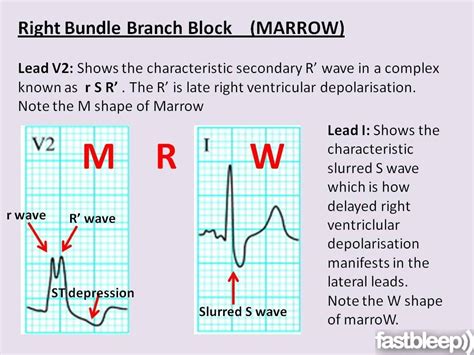 Right Bundle Branch Block Rbbb Almost Always Has A Pathological Cause