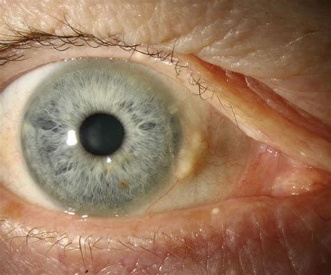 An Atlas Of Conjunctival And Scleral Anomalies