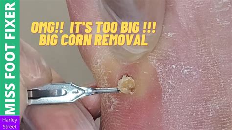 Corn Foot What Is It At Diane Rearick Blog