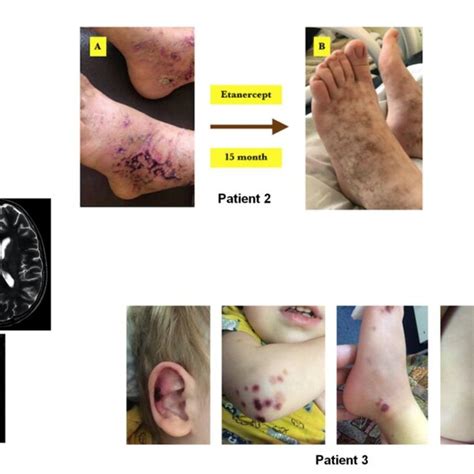 1 Intraoperative Pictures Of Patient 1 Mesenteric Vein Thrombosis