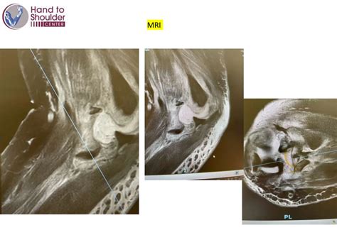 Coronoid Fracture Fix Or Notpptx