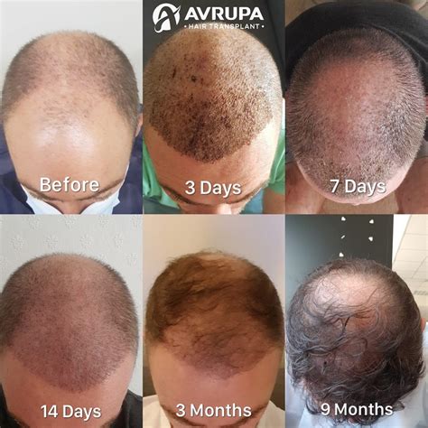 Hair Transplant Recovery Time Expectations Timeline And Precautions