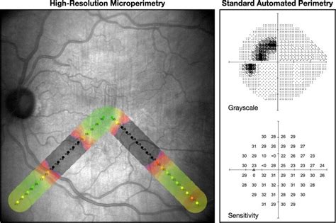 High Res Microperimetry Better Than Sap