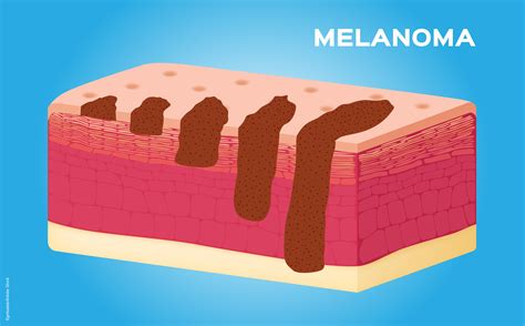 Advanced Melanoma Ici Combo Improves Pfs With No Decrease In Hrqol