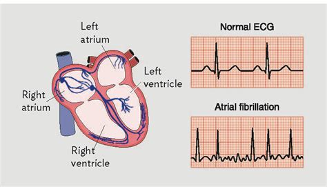 Step By Step Approach To Afib With Rvr — Kwak Talk