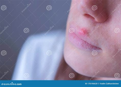 Herpes Virus On Human Lips Woman With Herpes Sore On Lip Mouth