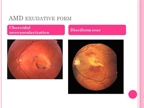 Retina Švehlíková G Lf Upjs V Košiciach Ppt Video Online Download