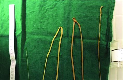 Approximately 300 Cm Of The Tapeworm Passed After The Combination Download Scientific Diagram