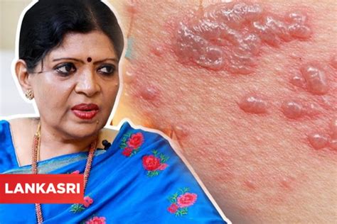 பெண் உறுப்பில் ஏற்படும் Rashes க்கு என்ன தீர்வு மருத்துவர் கூறும்