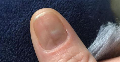 Scots Mums Bruise Under Fingernail Turned Out To Be Rare Skin Cancer Daily Record