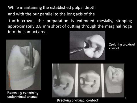 Class Ii Amalgam