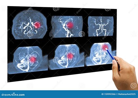 Mra Brain Or Magnetic Resonance Angiography Of Cerebral Artery In The