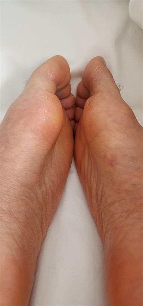 Lump Under Toe Following Metatarsalgia R Footfunction