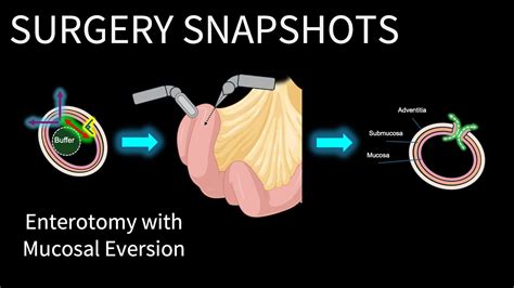 Enterotomy With Mucosal Eversion Step By Step Surgical Technique Youtube