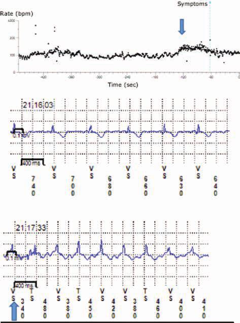 Loop Recorder Representative Strip Of A Gradual Increase In Sinus Rate