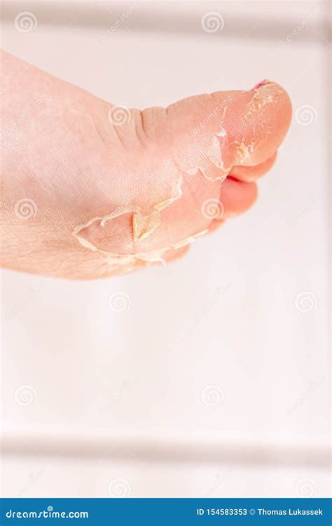 Scarlet Fever Rash Peeling