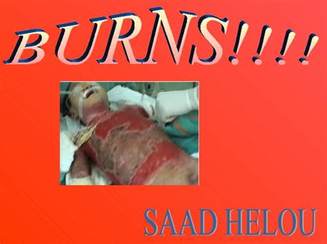 Burns Ppt