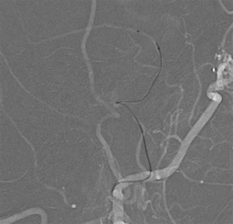 Mma Recurrent Meningeal Artery Variant Collateral Embolization