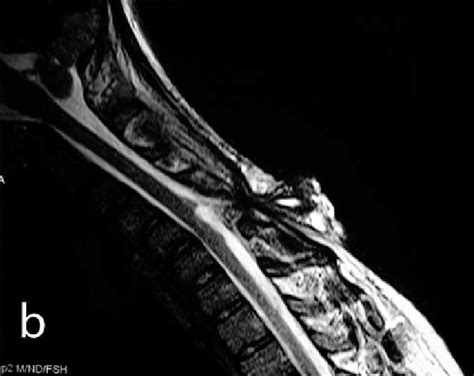 B T2 Weighted Cervical Mri In Hyperflexion Cervical Meningocele At