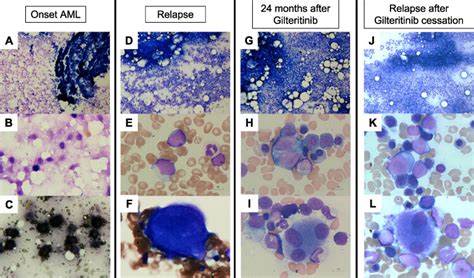 Bone Marrow Smear At Onset Of Aml First Relapse Of Aml 24 Months Download Scientific Diagram