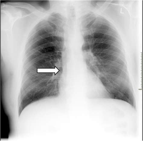 Radiologist Variability In Assessing The Position Of The Cavoatrial