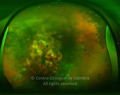 Caso Clínico 7 Atlas Rl Eye