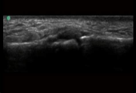Hand Mcp Ulnar Collateral Ligament Image Sonosite Institute For Point